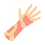 Photodermatitis (Sun Allergy Rash): Symptoms, Causes, and Treatment ...