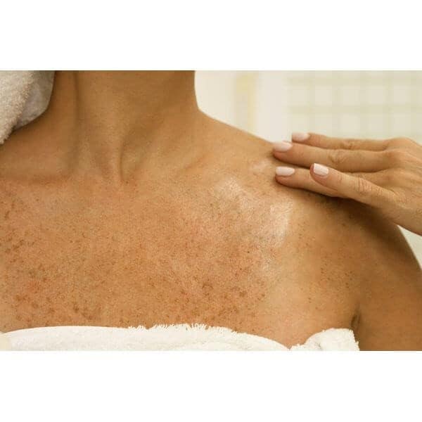 Cure White Spots On The Skin From Tanning Bed - Allergy Gate